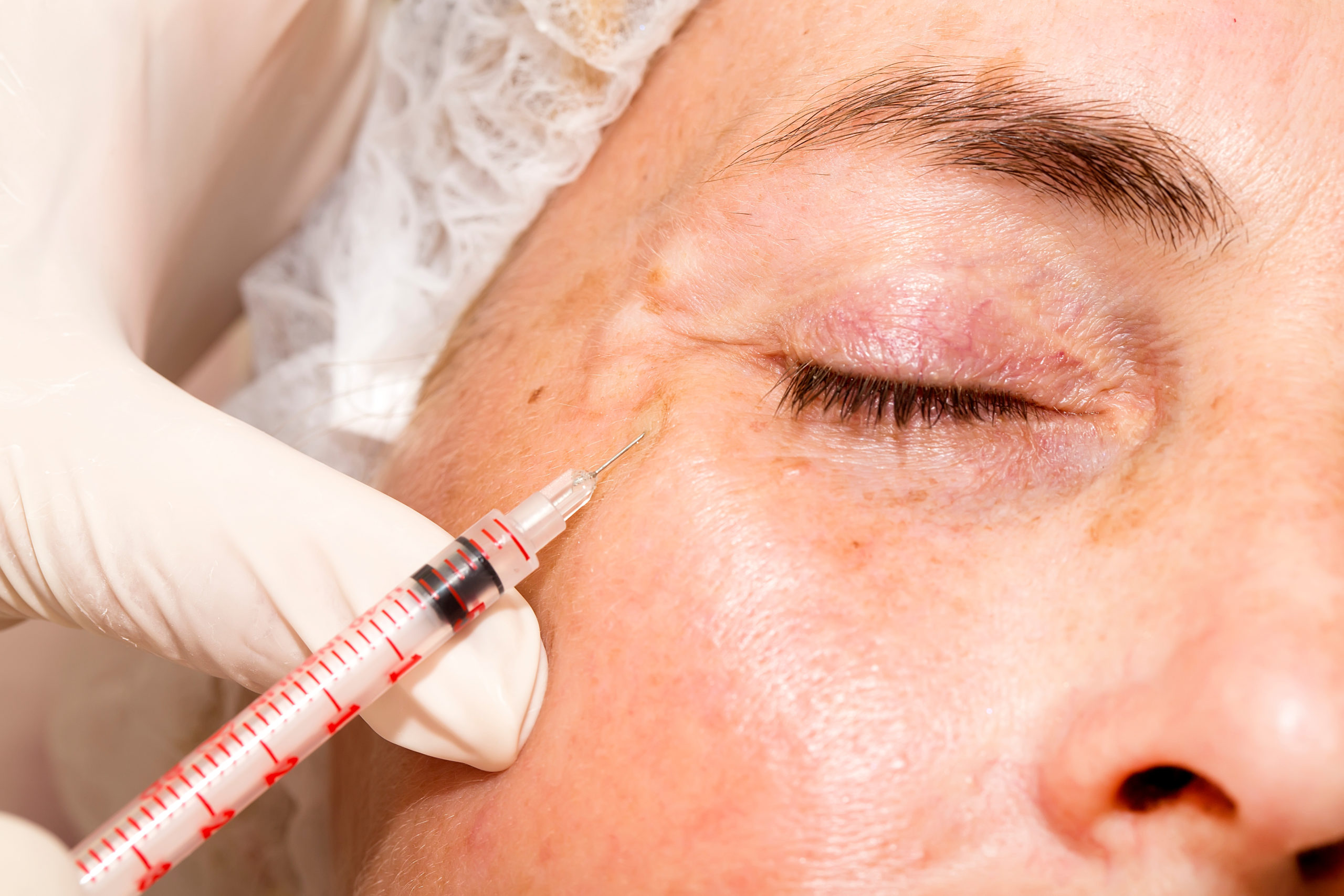What Is Botox Treatment? | OC Cosmetic and Vein Center | Brea CA